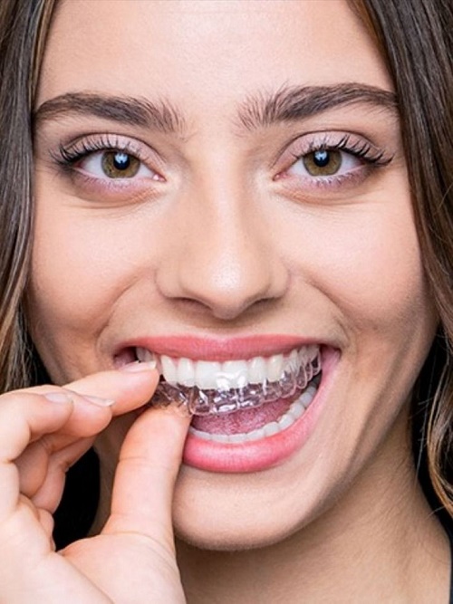 Más allá de lo invisible: la nueva era de los alineadores en belleza y ...
